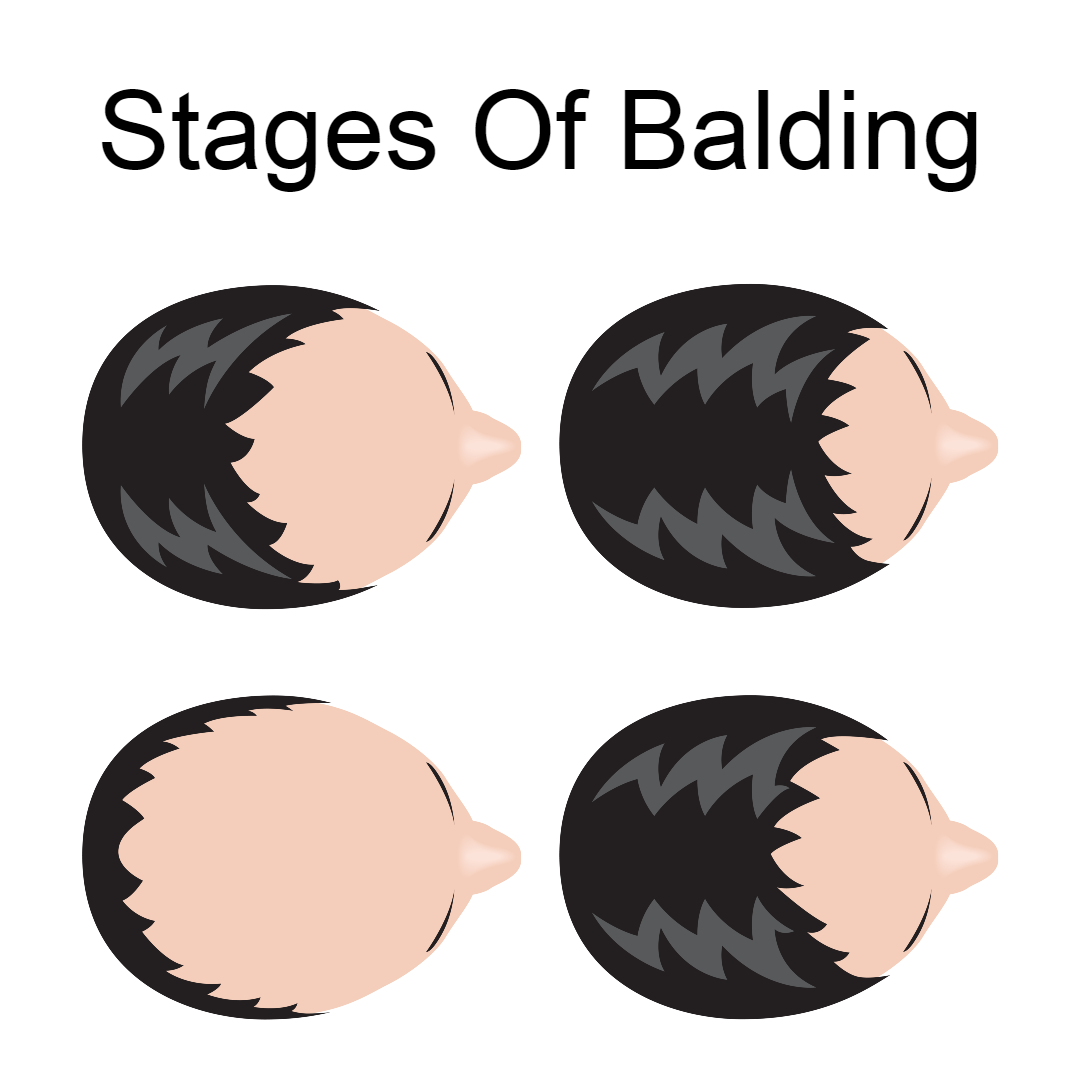 7 Stages Of Balding: Which Balding Stage Are You? – Scandinavianbiolabs.com